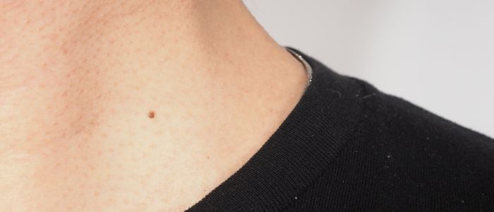 Alverox — The Revolutionary Wart Solution You’ve Been Waiting For ...